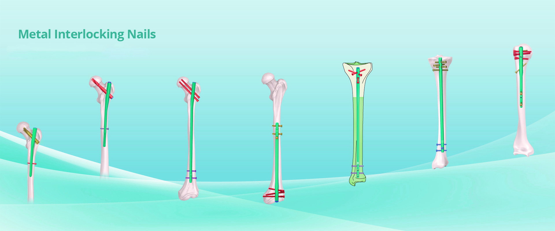 orthopaedic implants, orthopaedic instruments, locking plate ...