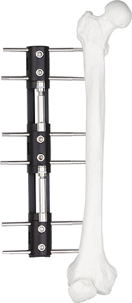 The most reliable orthopaedic implants, locking plates - JINLU