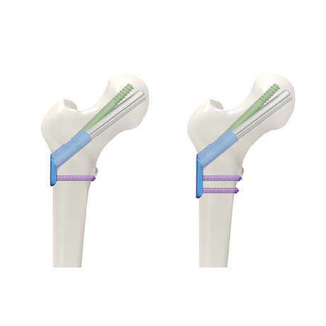 New Product FNS System for Femur Neck Fracture Interlocking Nails from ...